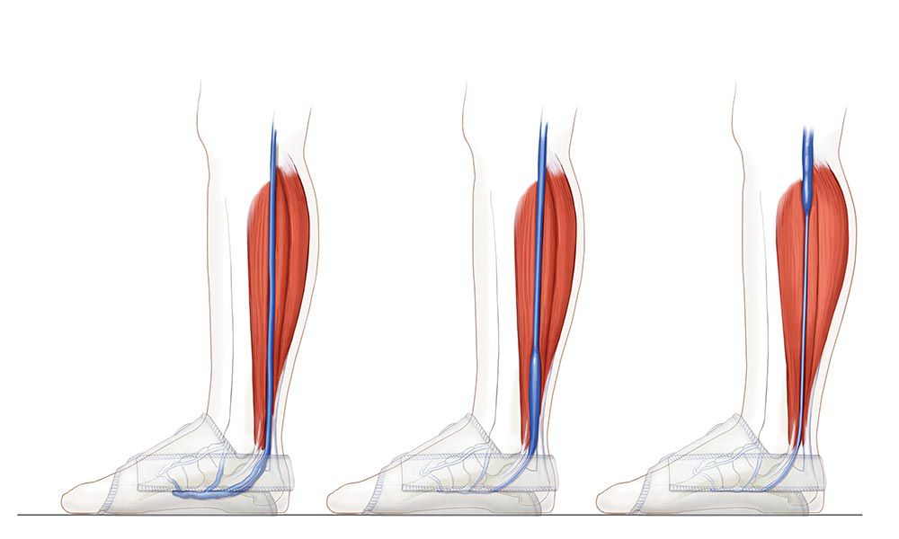 AV Impulse™ Foot Compression System | Cardinal Health